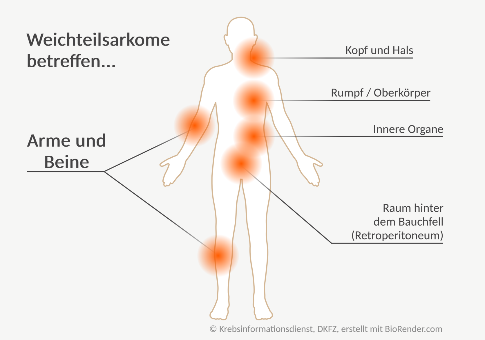Weichteilsarkome: Prognose, Einteilung, Häufigkeit | DKFZ ...
