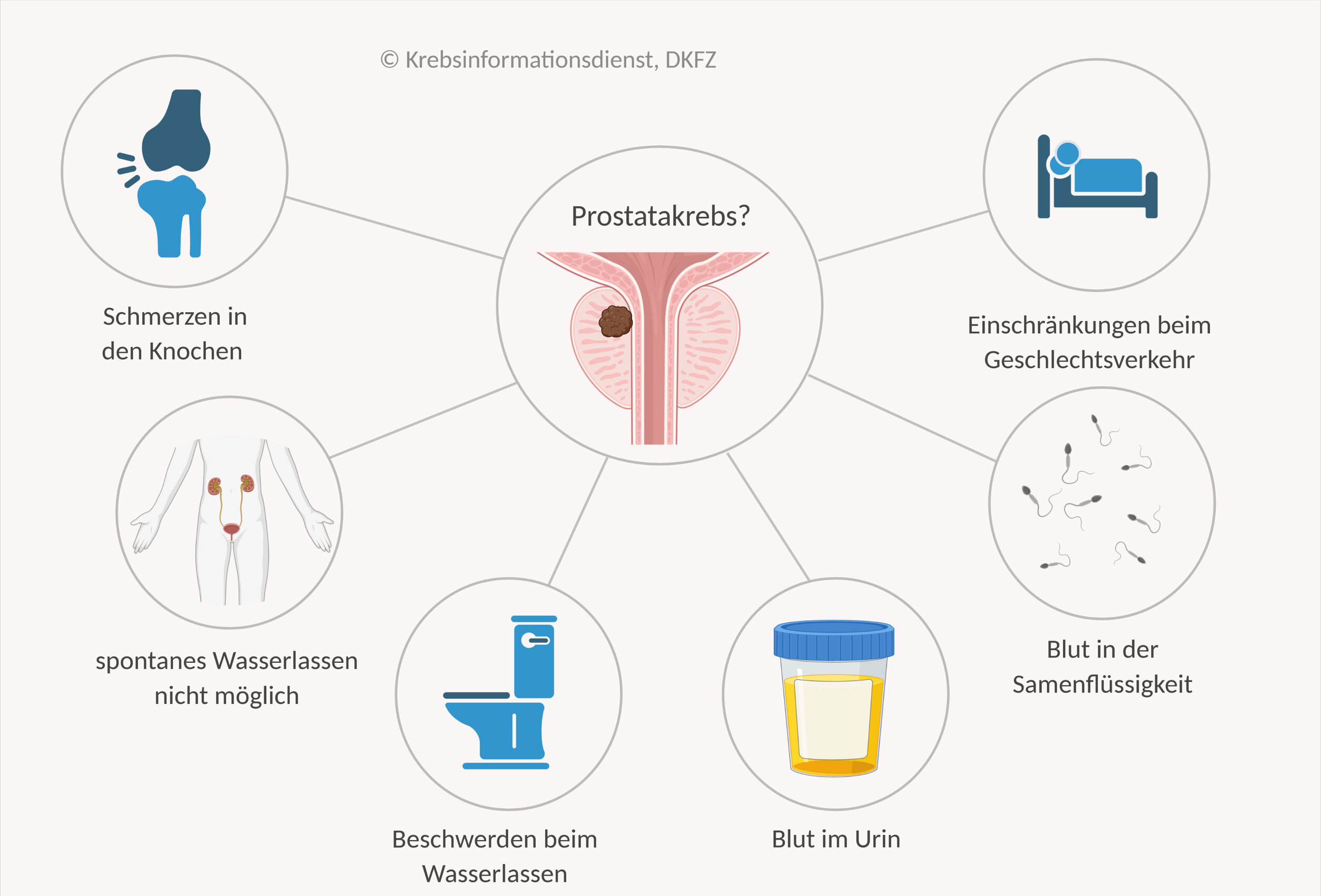 Prostatakrebs: Symptome und Anzeichen | DKFZ - Krebsinformationsdienst