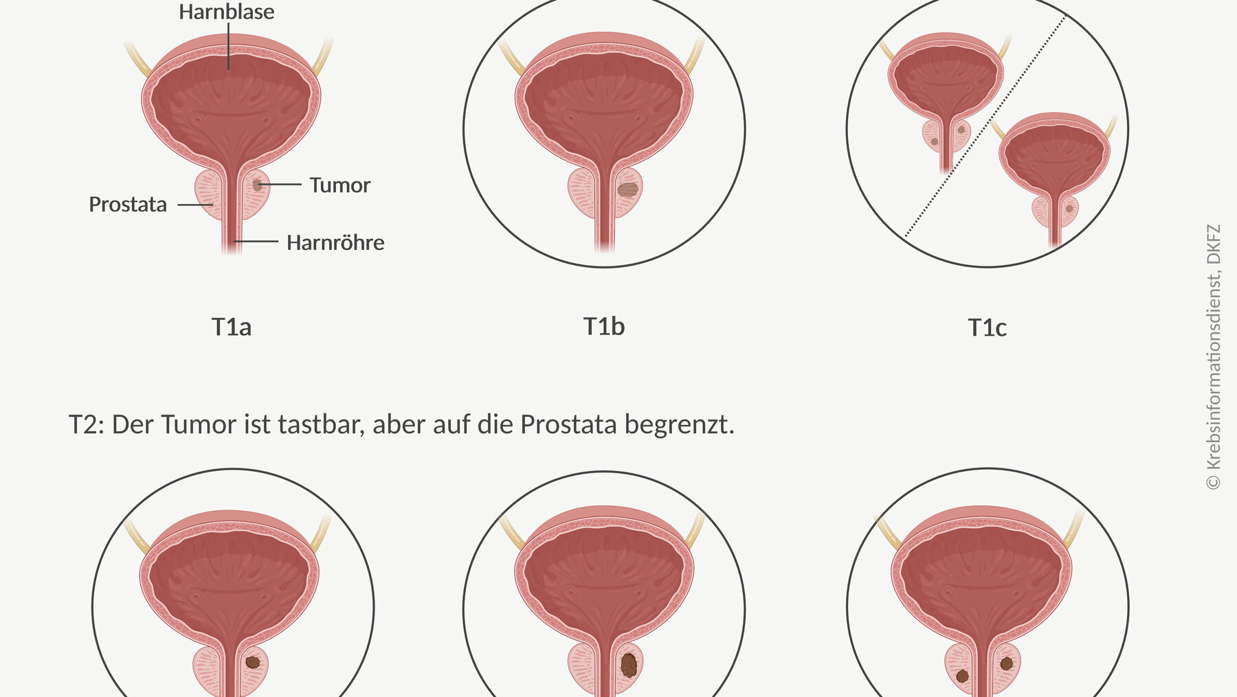 Prostatakrebs: Definition, Prognose und Häufigkeit | DKFZ ...