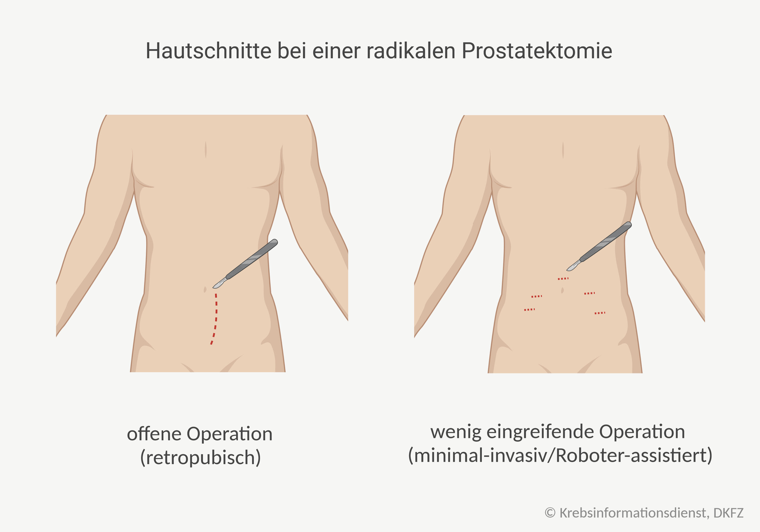 Therapie bei Prostatakrebs: Radikale Prostatektomie | DKFZ - Krebsinformationsdienst