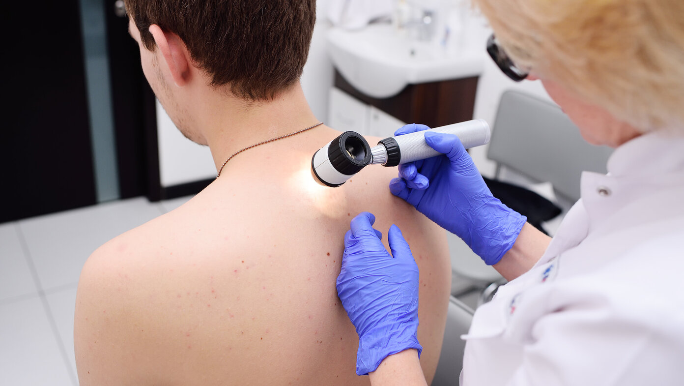 Erhöhtes Krebsrisiko nach Basalzellkarzinom (Basaliom)? | DKFZ ...